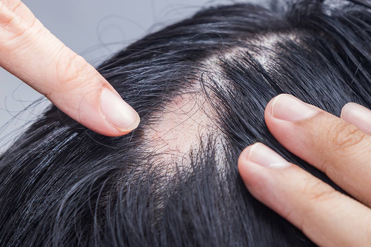 Buchi nei capelli: come capire se è alopecia areata